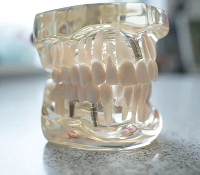 Replace missing teeth with Dental Implants in Chudleigh